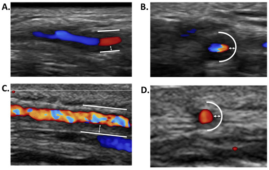 Temporal Artery Vascular Diseases
