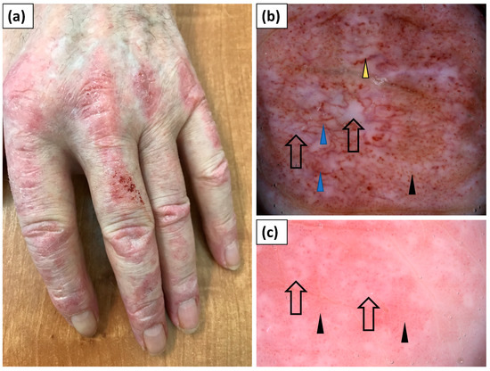 Dermoscopy and Trichoscopy in Dermatomyositis—A Cross-Sectional Study