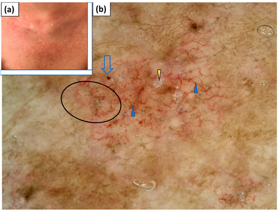 Dermoscopy and Trichoscopy in Dermatomyositis—A Cross-Sectional Study