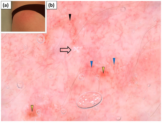 Dermoscopy and Trichoscopy in Dermatomyositis—A Cross-Sectional Study