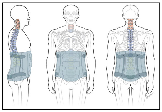 An Indication-Based Concept for Stepwise Spinal Orthosis in Low Back ...