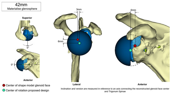 Functional and Radiological Outcomes after Treatment with Custom-Made ...