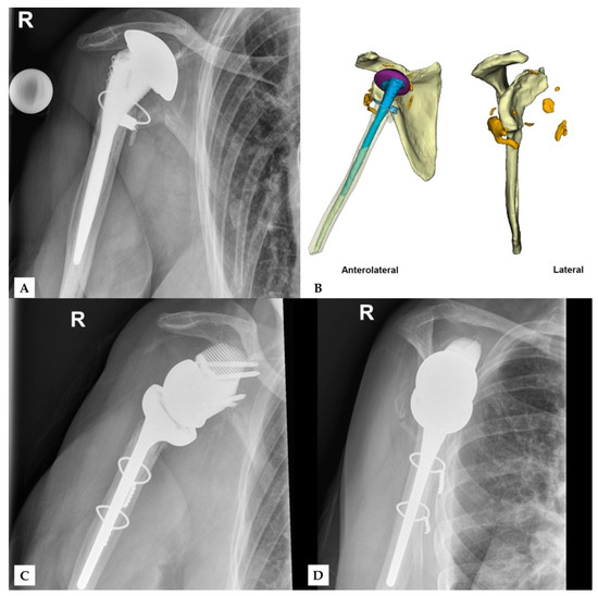 Functional and Radiological Outcomes after Treatment with Custom-Made ...