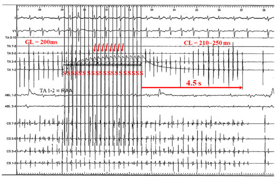 Utility of Simultaneous Biatrial Atrial Anti-Tachycardia Pacing for the ...