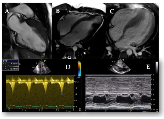 Multimodality Cardiac Imaging in Cardiomyopathies: From Diagnosis to Prognosis