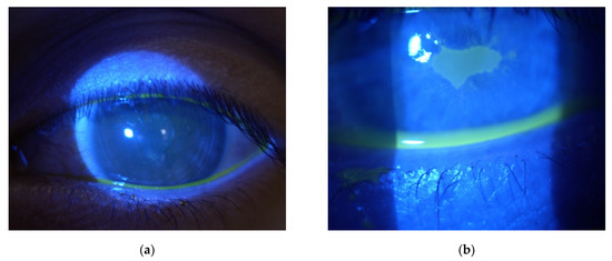 Subepithelial Infiltrates Staining