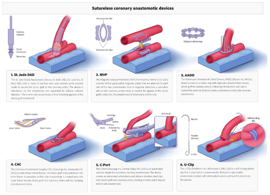 Sutureless versus Hand-Sewn Coronary Anastomoses: A Systematic Review ...