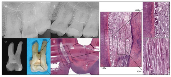 Short-Term Pain Evolution and Treatment Success of Pulpotomy as ...