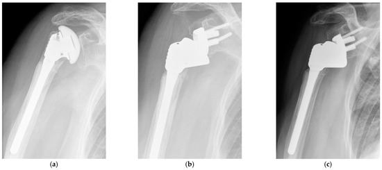 Conversion of Hemiarthroplasty to Reverse Shoulder Arthroplasty with ...
