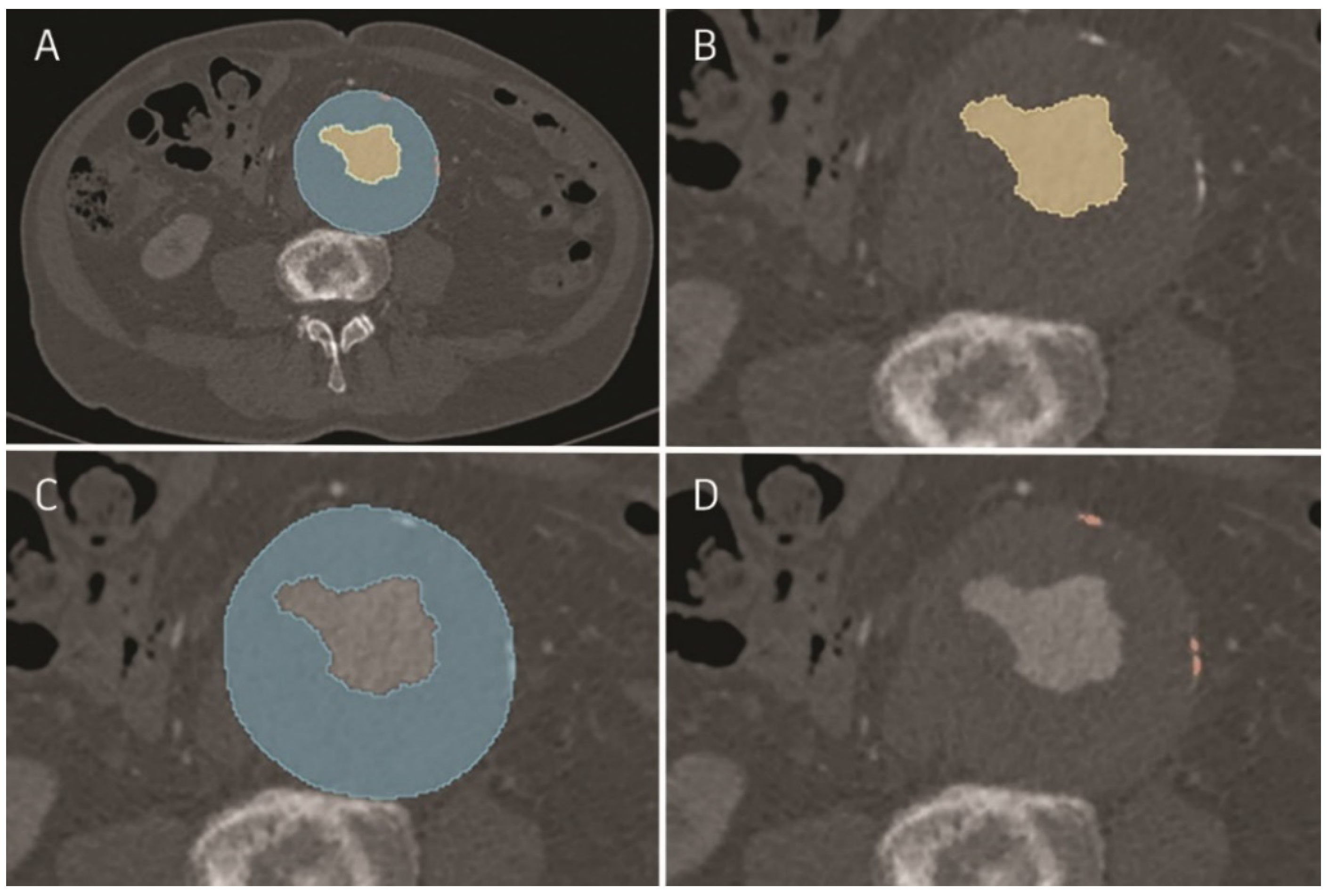 Abdominal Aortic Aneurysm Morphology as an Essential Criterion for ...