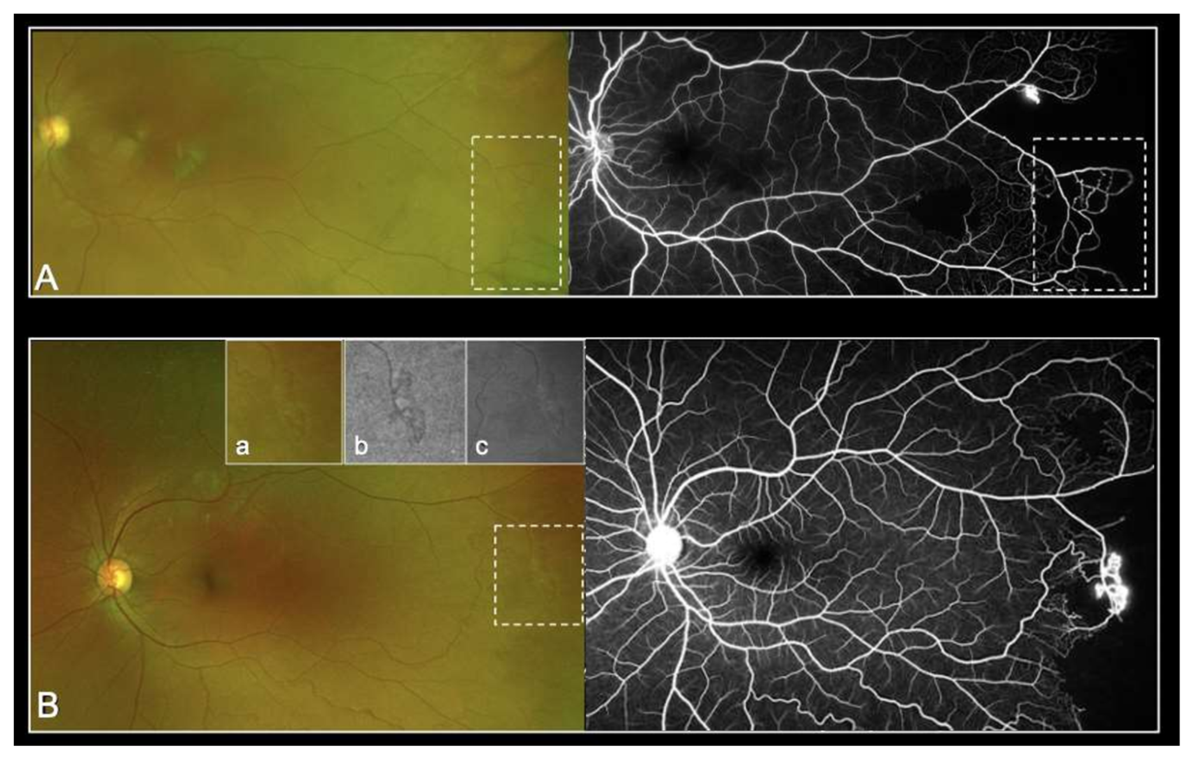 Sickle Cell Retinopathy Sea Fan