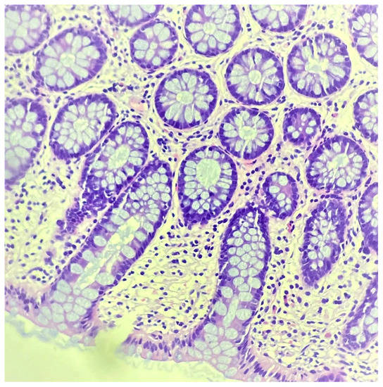 Histological Scores in Patients with Inflammatory Bowel Diseases: The ...