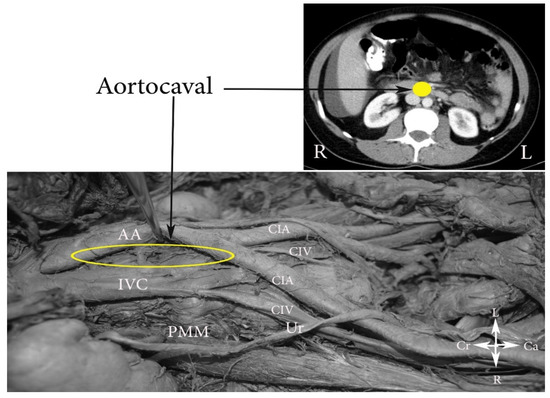 JCM | Free Full-Text | Paraaortic Lymphadenectomy in Gynecologic ...