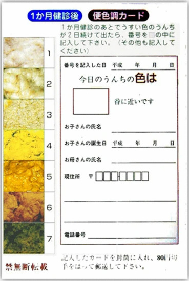 Biliary Atresia in 2021: Epidemiology, Screening and Public Policy