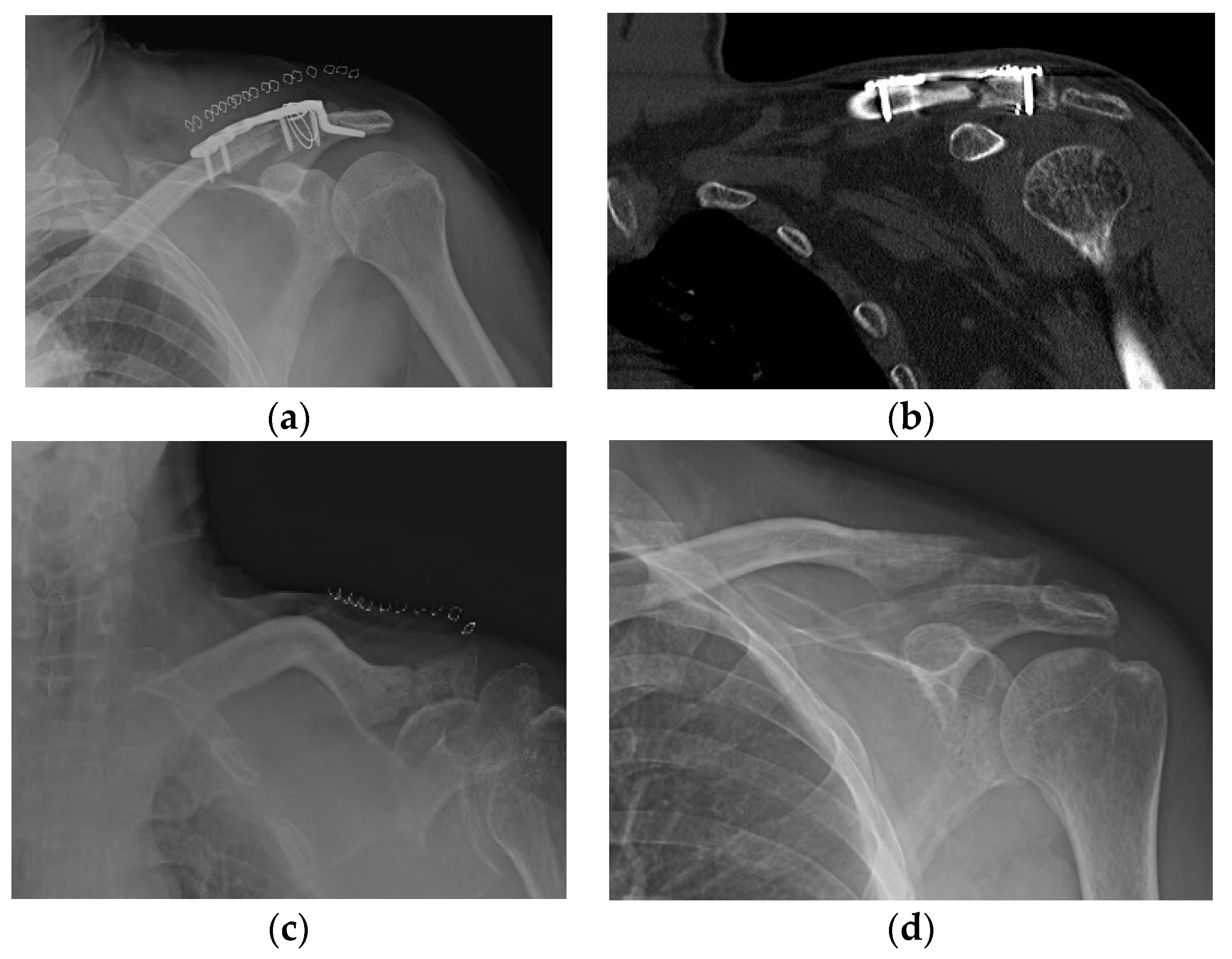 Complications and Frequency of Surgical Treatment with AO-Type Hook ...