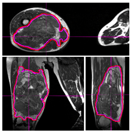 The Role of MRI-Guided Radiotherapy for Soft Tissue Sarcomas