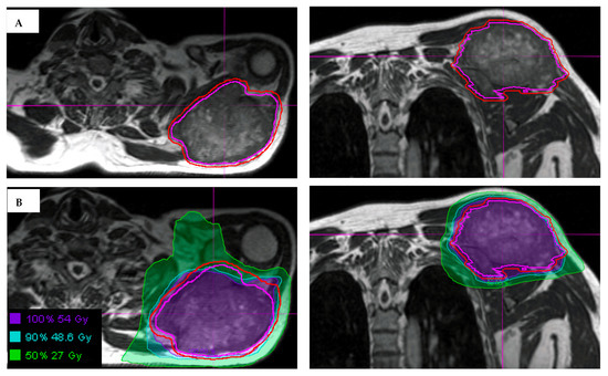 The Role of MRI-Guided Radiotherapy for Soft Tissue Sarcomas