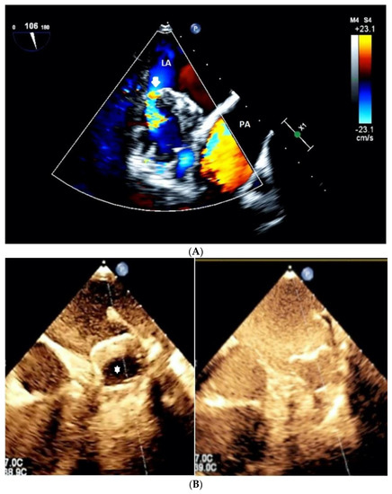 A Novel Echocardiographic-Based Classification for the Prediction of ...