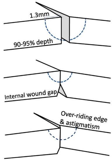 Update on Suture Techniques in Corneal Transplantation: A Systematic Review