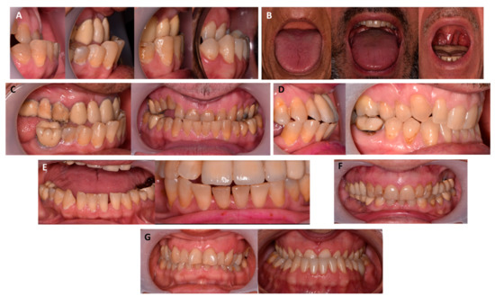 Oral Manifestations and Maxillo-Facial Features in the Acromegalic ...