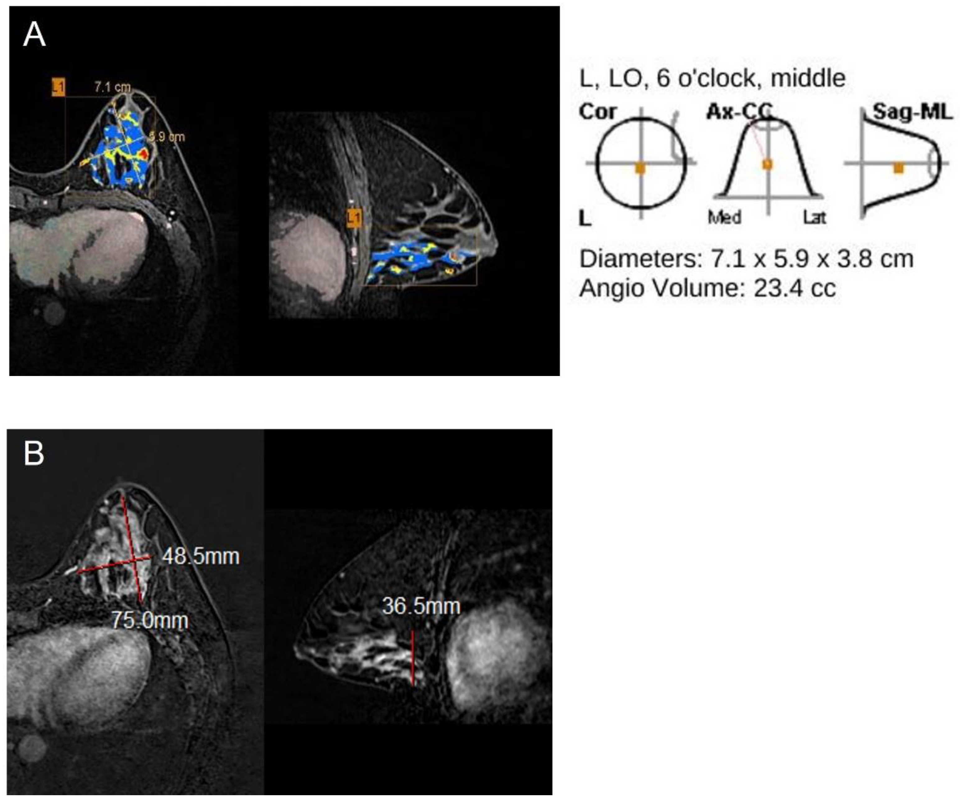 Evaluation of Breast Cancer Size Measurement by Computer-Aided ...