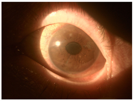 Endogenous Endophthalmitis—The Clinical Significance of the Primary ...