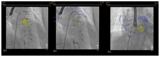 JCM | Free Full-Text | Mitral Paravalvular Leak: Clinical Implications ...