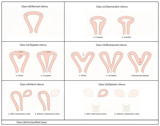 Diagnosis of Congenital Uterine Abnormalities: Practical Considerations