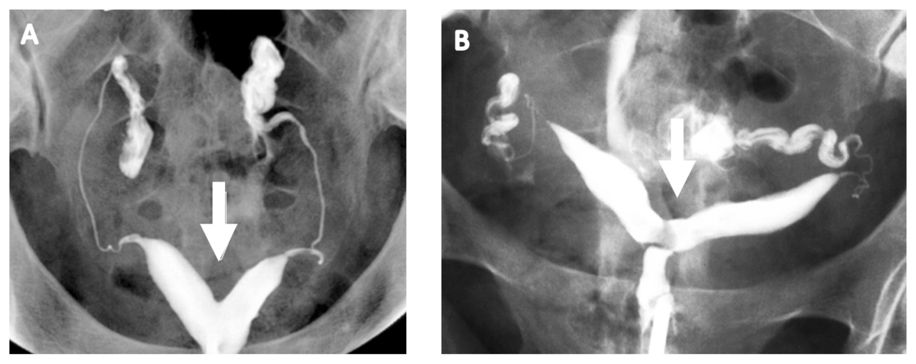 Jcm Free Full Text Diagnosis Of Congenital Uterine Abnormalities