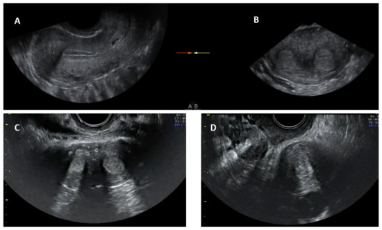 Diagnosis of Congenital Uterine Abnormalities: Practical Considerations