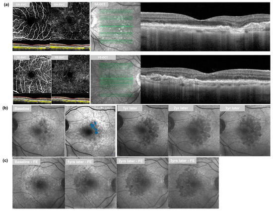 Retinal Vessel Density in Age-Related Macular Degeneration Patients ...