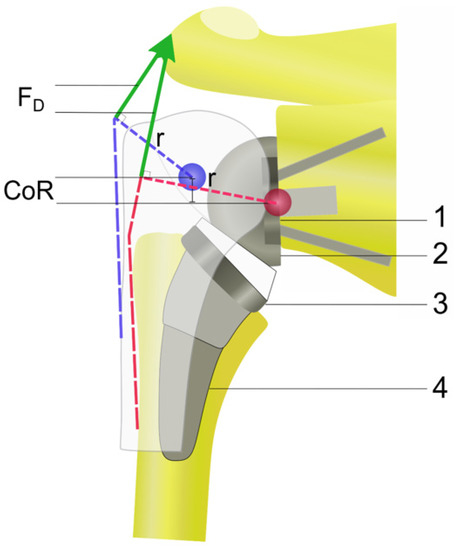 The Evolution of Reverse Total Shoulder Arthroplasty—From the First ...