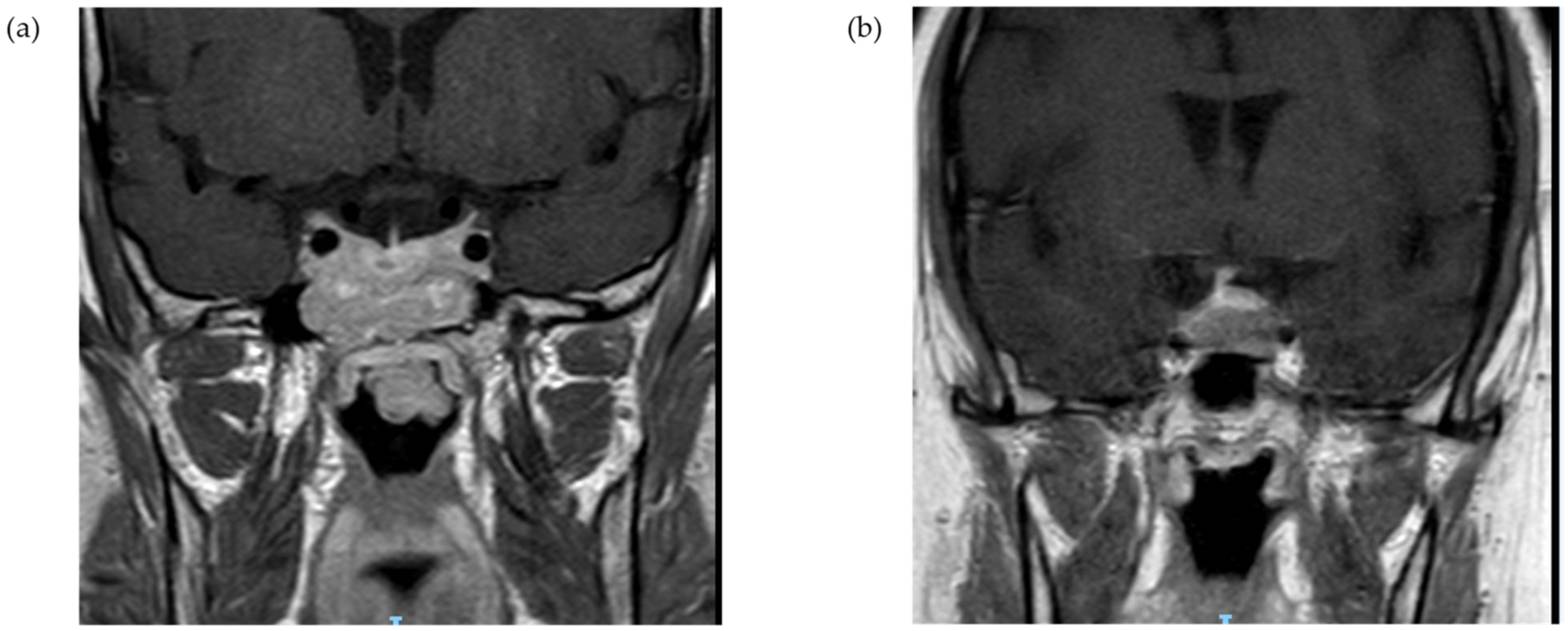 Clinical Study and Systematic Review of Pituitary Microadenomas vs. Macroadenomas in Cushing’s ...
