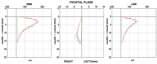 Chewing Patterns and Muscular Activation in Deep Bite Malocclusion