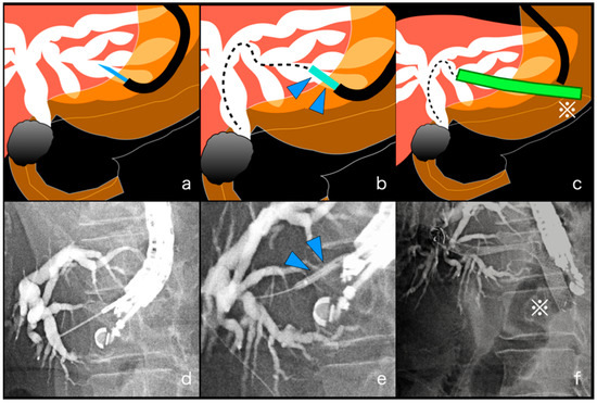 Comparison of Radiation Exposure between Endoscopic Ultrasound-Guided ...