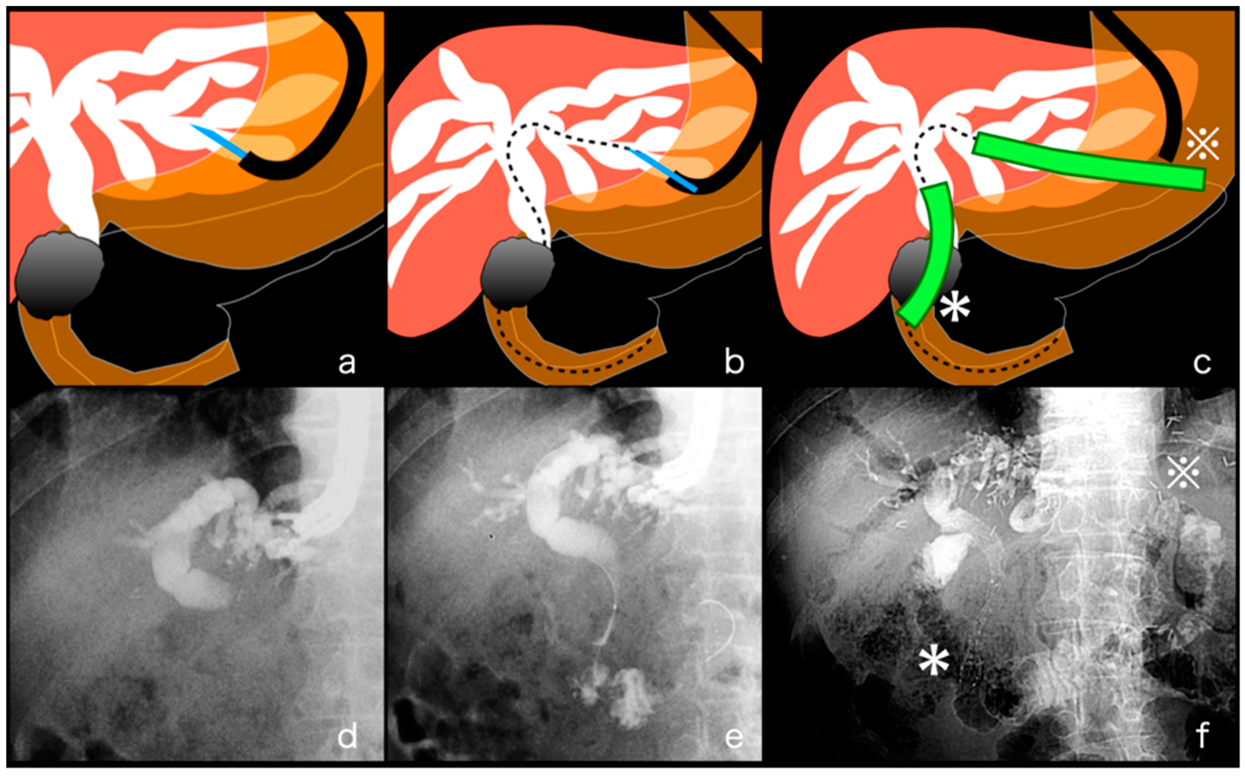 Comparison of Radiation Exposure between Endoscopic Ultrasound-Guided ...