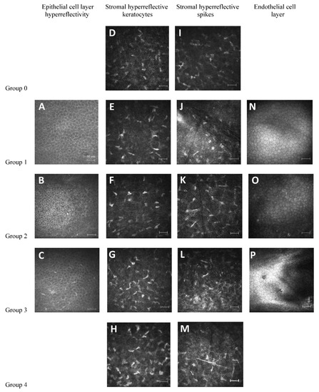 JCM | Free Full-Text | Corneal Densitometry and In Vivo Confocal Microscopy in Patients with ...