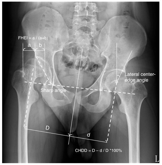 Radiographic Outcomes of Ganz versus Modified Triple Osteotomies in ...