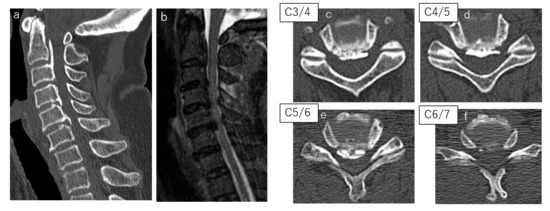 Efficiency of Long Lateral Mass Screws
