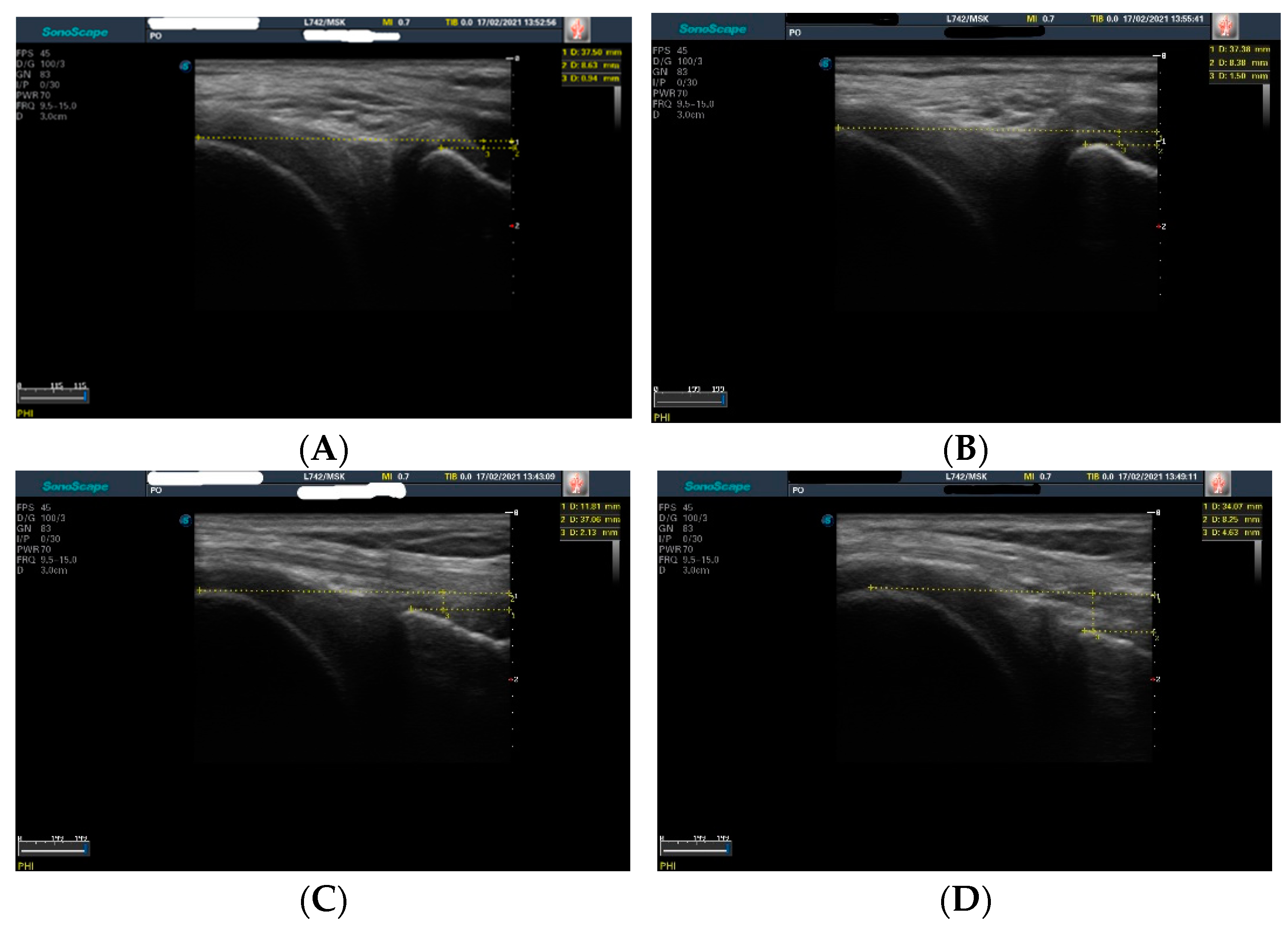 JCM | Free Full-Text | Dynamic Ultrasound Assessment of the Anterior ...