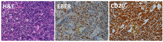 Management of Epstein–Barr Virus Infection and Post-Transplant ...