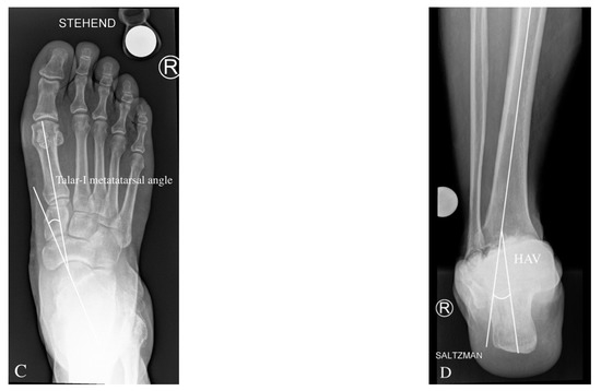 Joint-Preserving Surgery in Varus Ankle Osteoarthritis