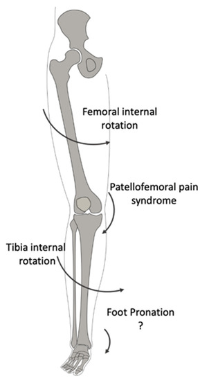 Does the Foot and Ankle Alignment Impact the Patellofemoral Pain ...