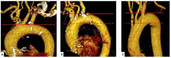 Impact of the Aortic Geometry on TAVI Prosthesis Positioning Using Self ...