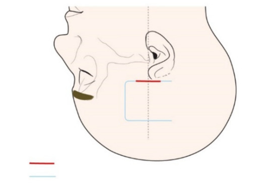 Endoscopic-Assisted Keyhole Middle Cranial Fossa Approach for Small ...