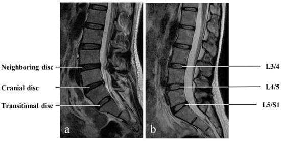 Lumbosacral Transitional Vertebra Contributed to Lumbar Spine ...