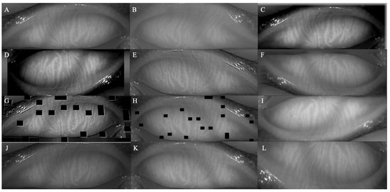 Meibomian Gland Density: An Effective Evaluation Index of Meibomian ...