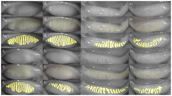 Meibomian Gland Density: An Effective Evaluation Index of Meibomian ...