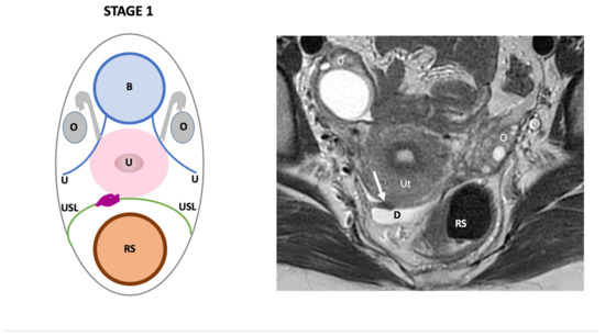 ENDO_STAGE Magnetic Resonance Imaging: Classification to Screen ...
