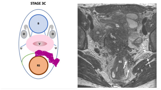 ENDO_STAGE Magnetic Resonance Imaging: Classification to Screen ...